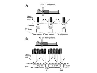 Respiratory gating | PPT