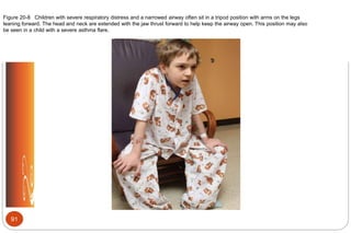 Tripod Position Respiratory Distress