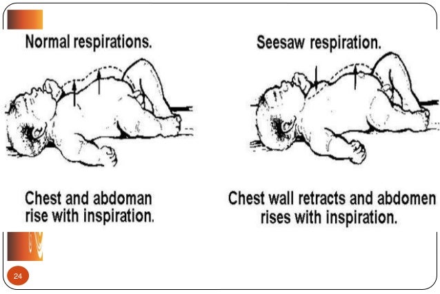 Respiratory lecture nurs 3340 spring 2017