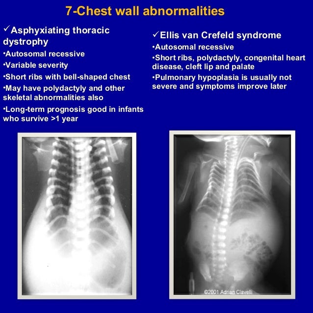 Respiratory problems in neonate