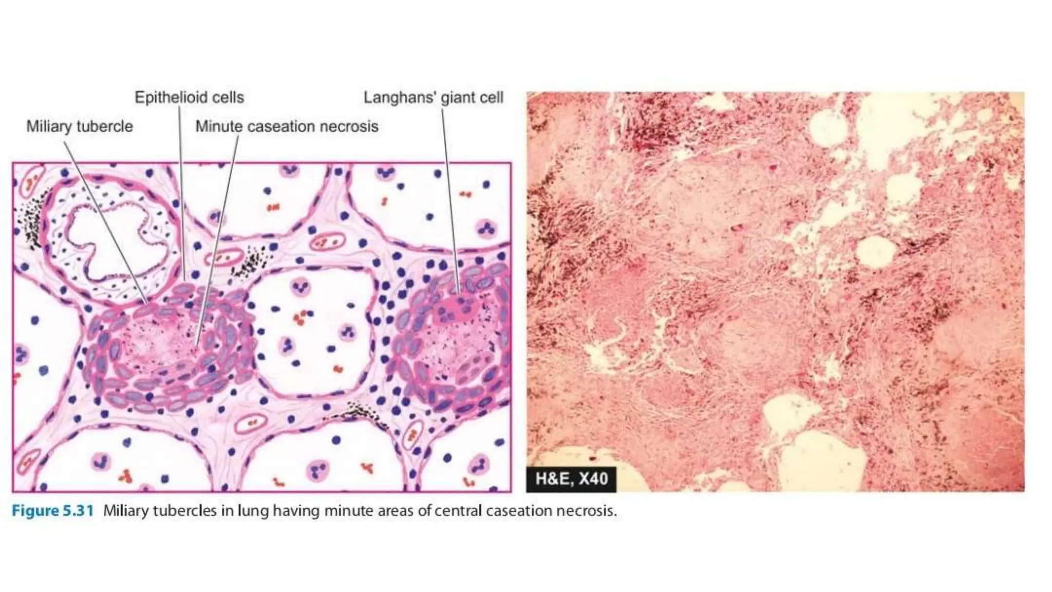 RESPIRATORY SYSTEM Tuberculosis pathology.pptx