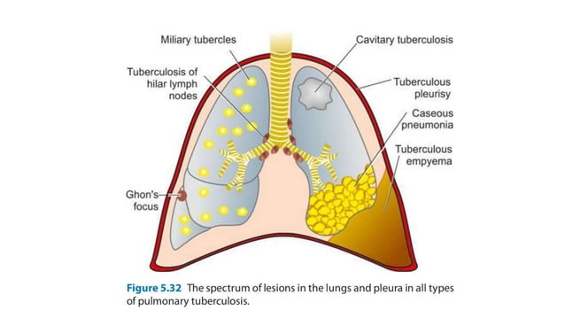 RESPIRATORY SYSTEM Tuberculosis pathology.pptx