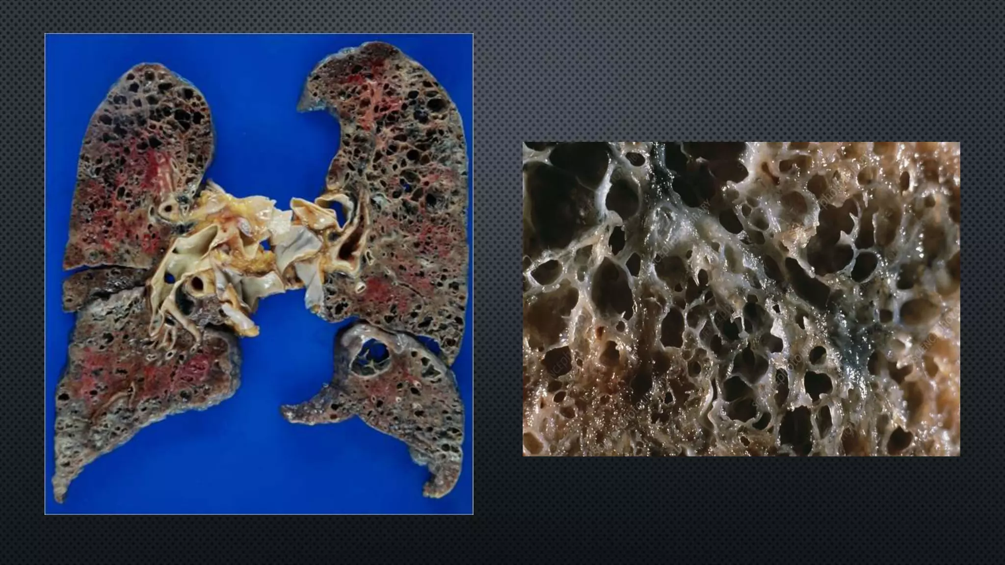 RESPIRATORY TRACT PATHOLOGY | PPTX