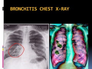 Respiratory tract infections | PPTX