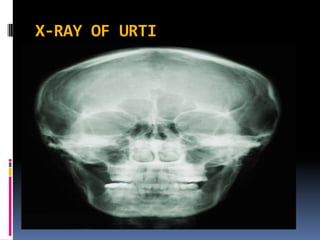 Respiratory tract infections | PPTX