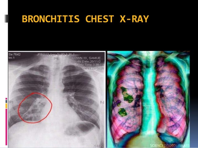 Respiratory tract infections