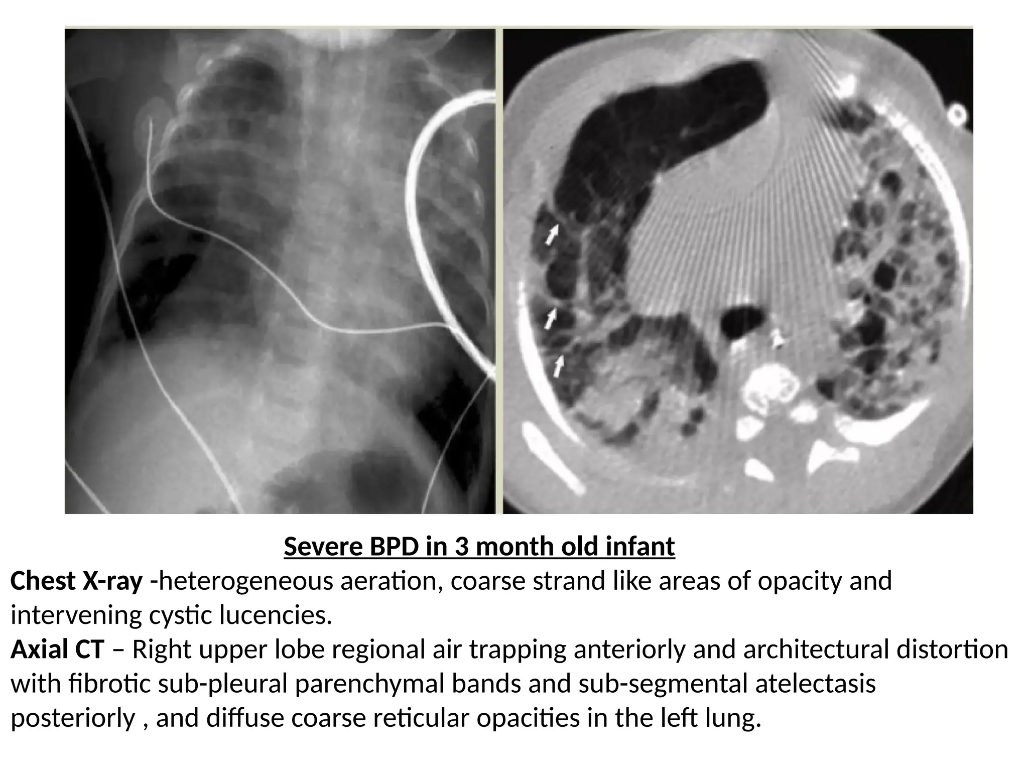 Respiratory distress in Newborn radiology aspect | PPTX