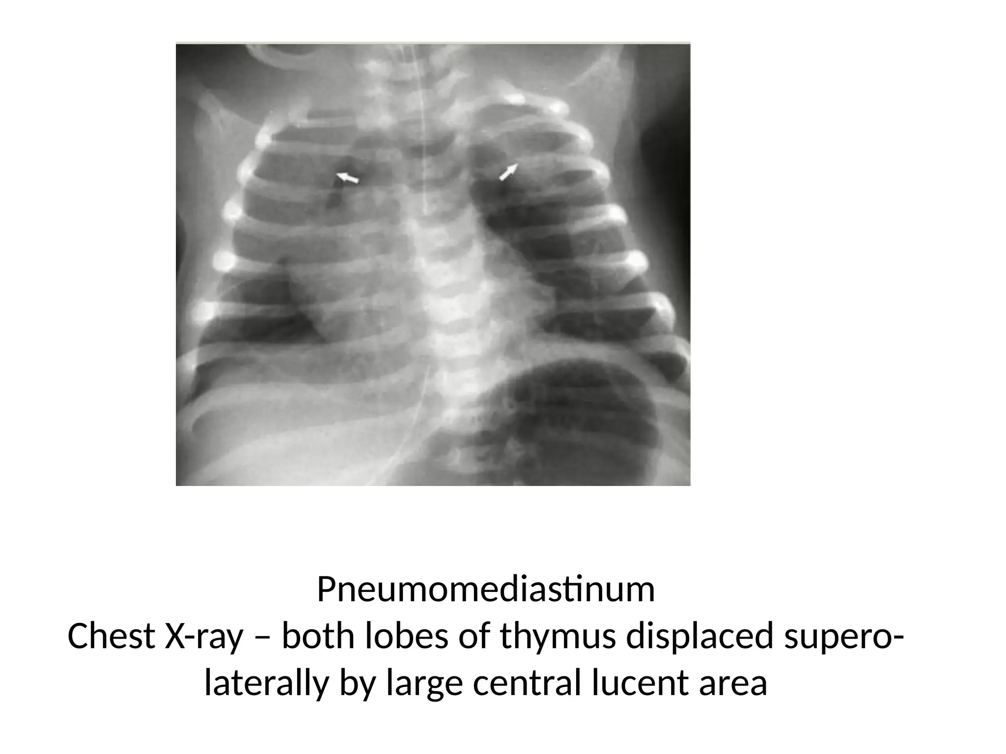 Respiratory distress in Newborn radiology aspect | PPTX