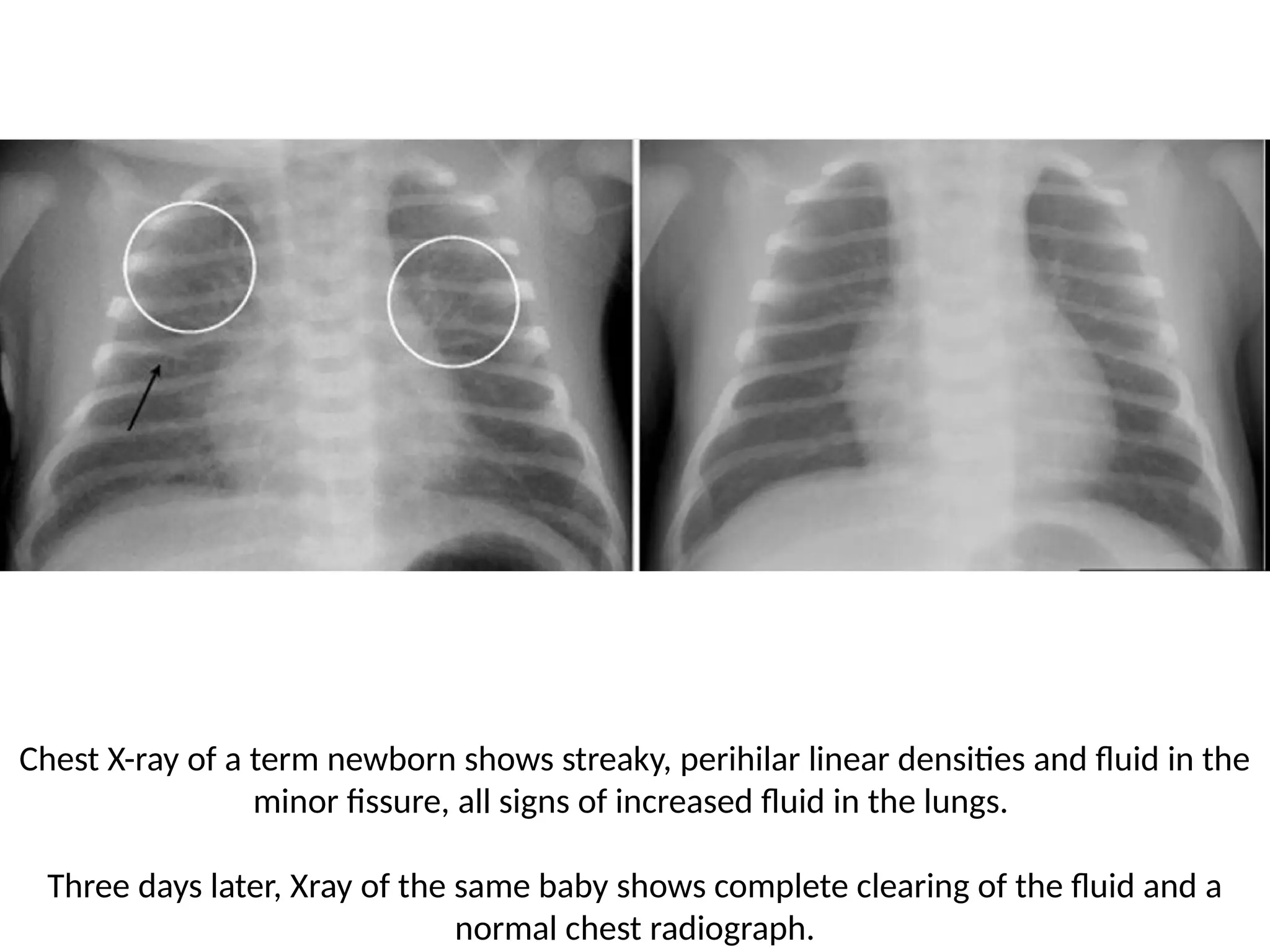 Respiratory distress in Newborn radiology aspect | PPTX