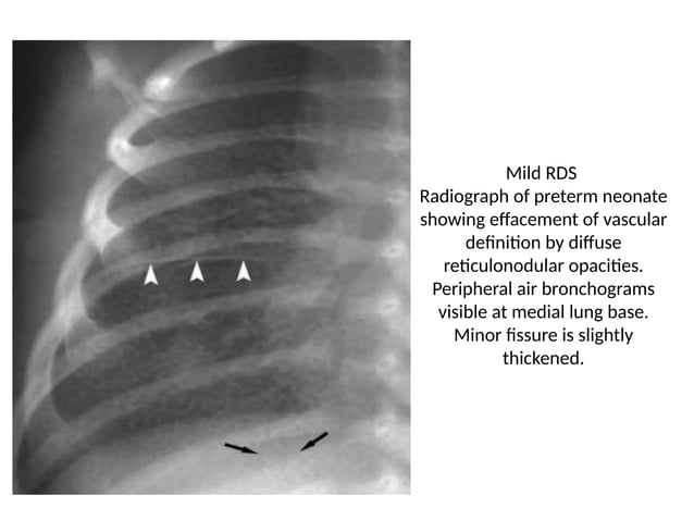 Respiratory distress in Newborn radiology aspect | PPTX