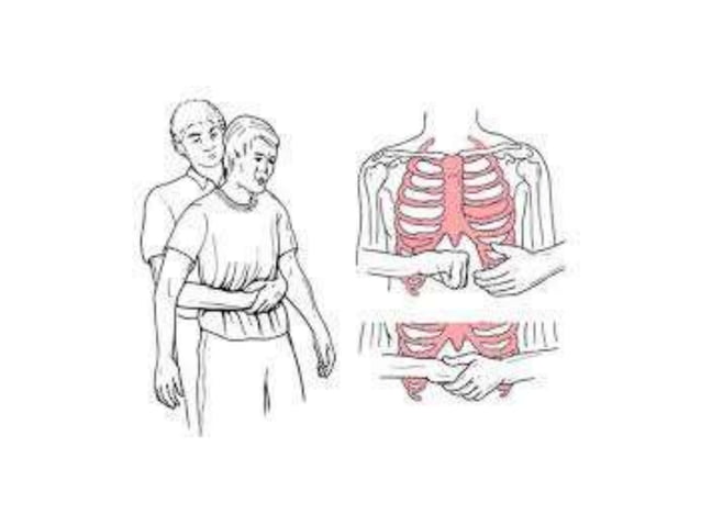Respiratory obstruction / Airway Obstruction | PPTX | First Aid | Injuries