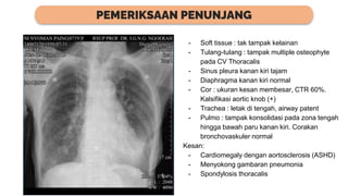 Responsi - Aritmia: Atrial Fibrillation. | PPTX