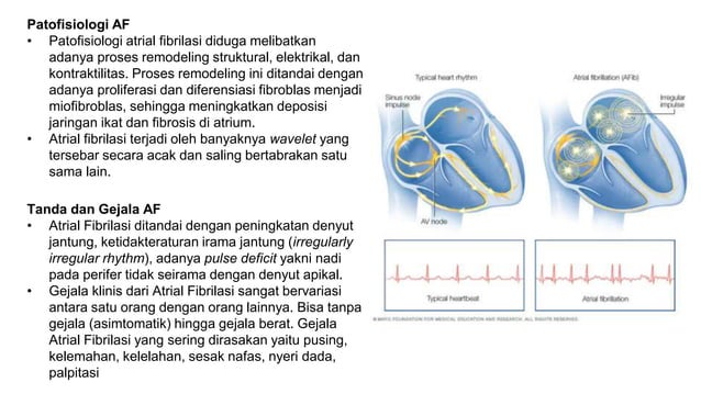 Responsi - Aritmia: Atrial Fibrillation. | PPTX