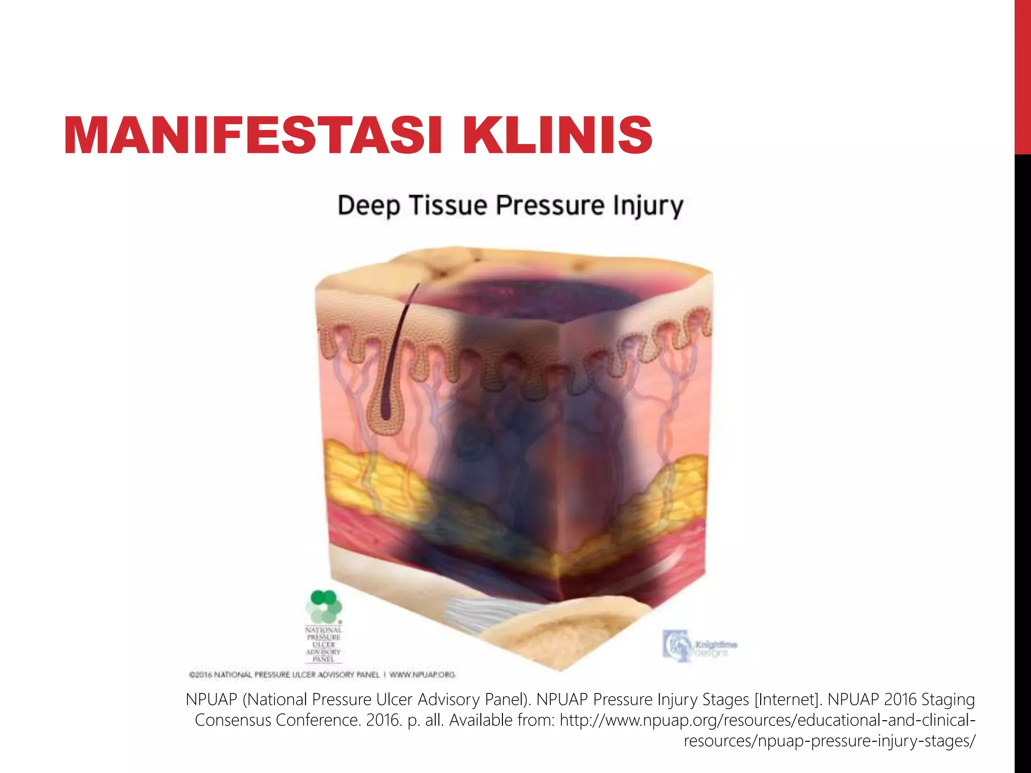 RESPONSI PRESSURE INJURY (ULKUS DEKUBITUS).pptx