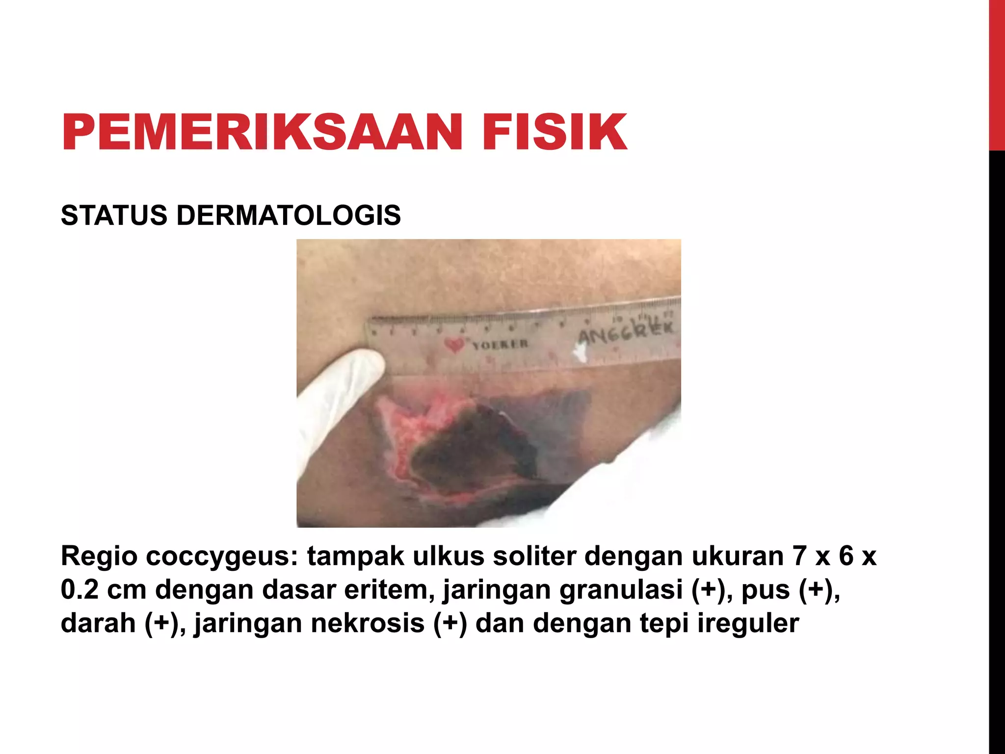 RESPONSI PRESSURE INJURY (ULKUS DEKUBITUS).pptx