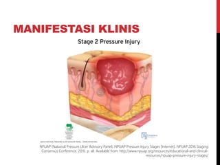 RESPONSI PRESSURE INJURY (ULKUS DEKUBITUS).pptx