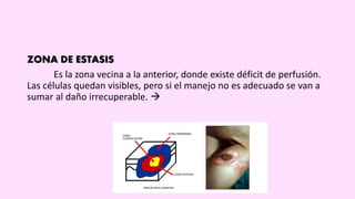 Respuesta fisiologica a la lesion por quemadura | PPT
