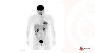 Response assessment criteria in FDG avid Lymphoma.pptx