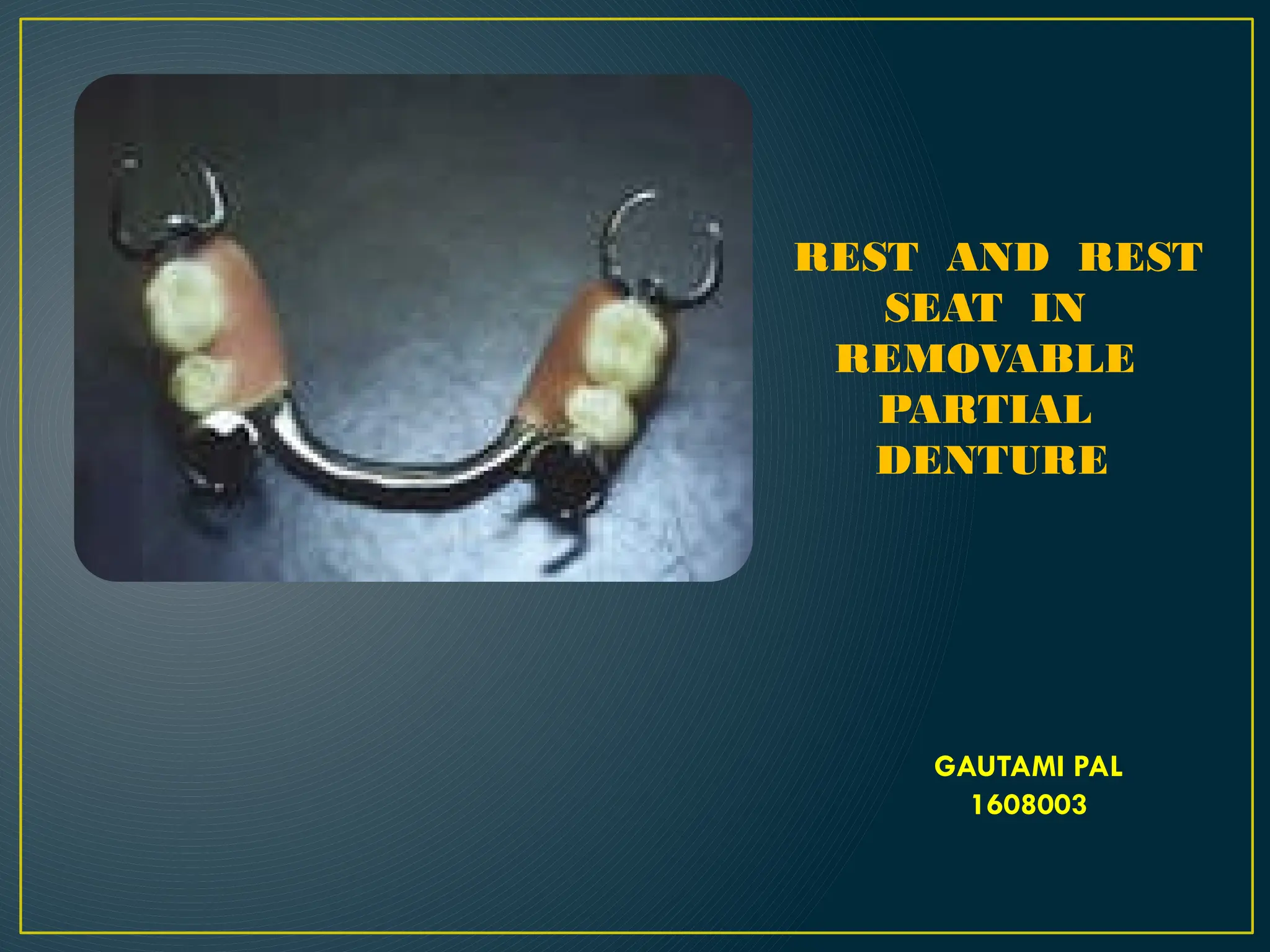 Rest and Rest Seat in Removable partial denture | PPTX