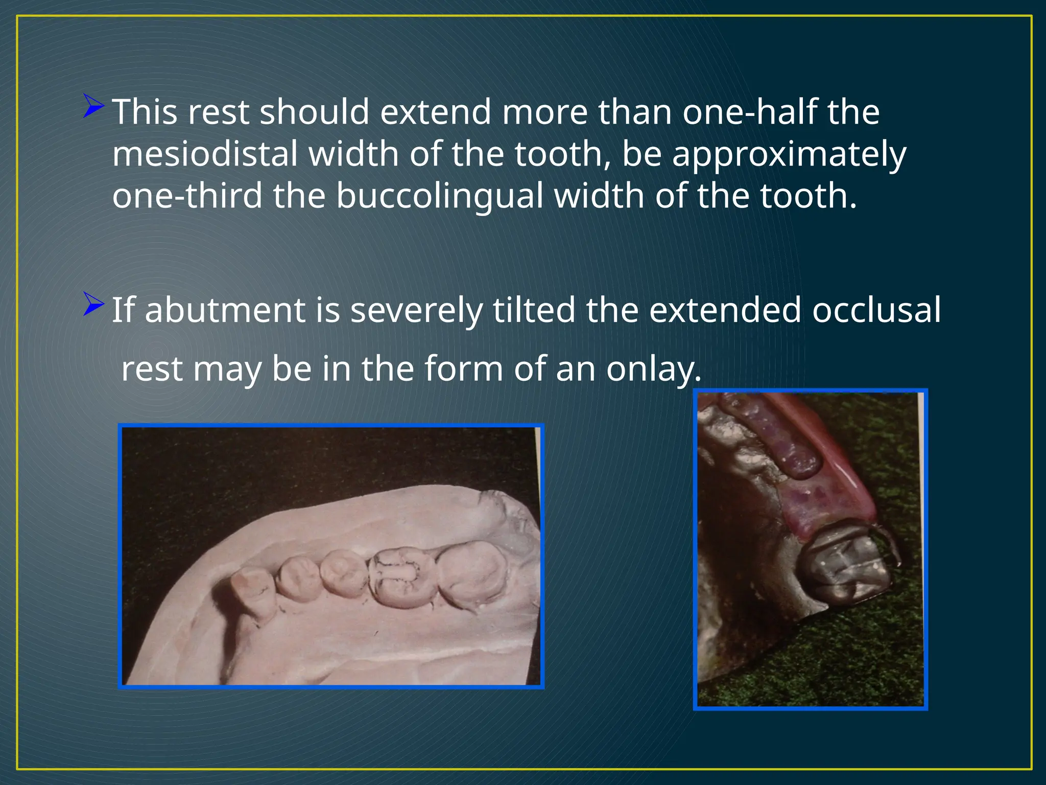 Rest and Rest Seat in Removable partial denture | PPTX