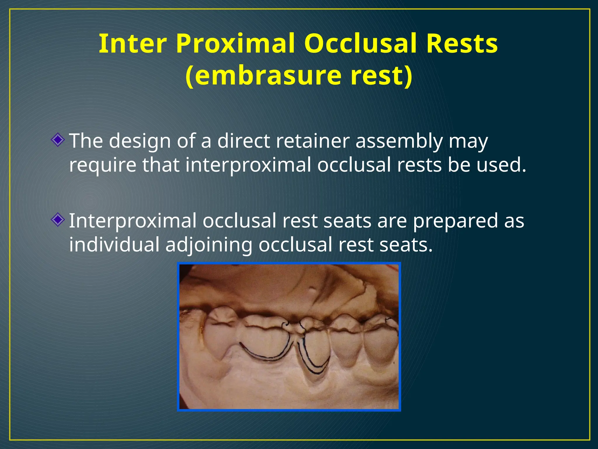 Rest and Rest Seat in Removable partial denture | PPTX