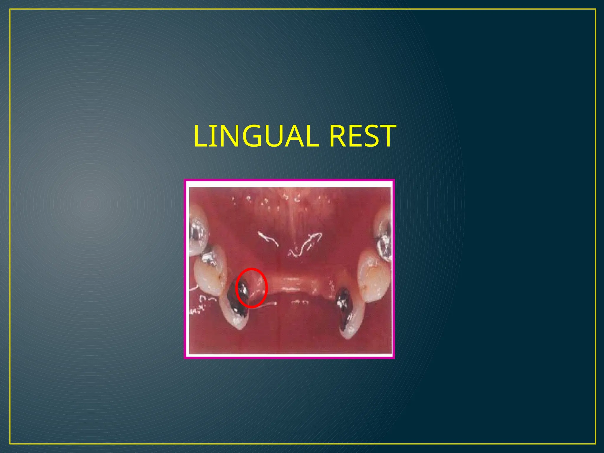 Rest and Rest Seat in Removable partial denture | PPTX