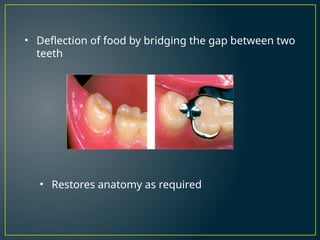 Rest and Rest Seat in Removable partial denture | PPTX