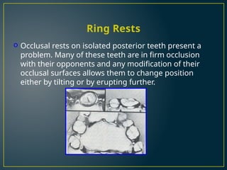 Rest and Rest Seat in Removable partial denture | PPTX