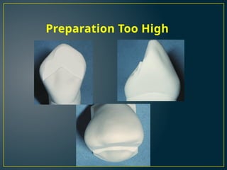 Rest and Rest Seat in Removable partial denture | PPTX