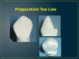 Rest and Rest Seat in Removable partial denture | PPTX