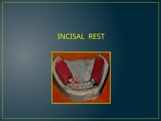 Rest and Rest Seat in Removable partial denture | PPTX