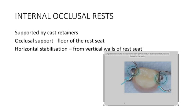 REST AND REST SEATS in prosthodontics ppt | PPTX