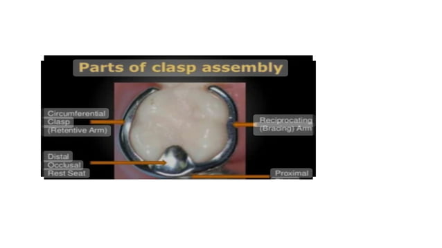 REST AND REST SEATS in prosthodontic dentistry | PPT