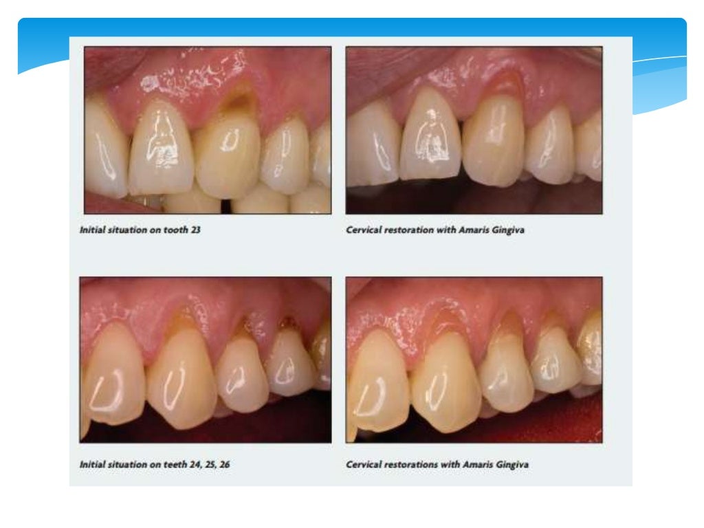 Restauración de caries radicular