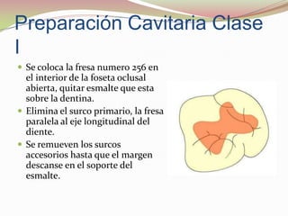 Restauraciones de amalgama | PPTX