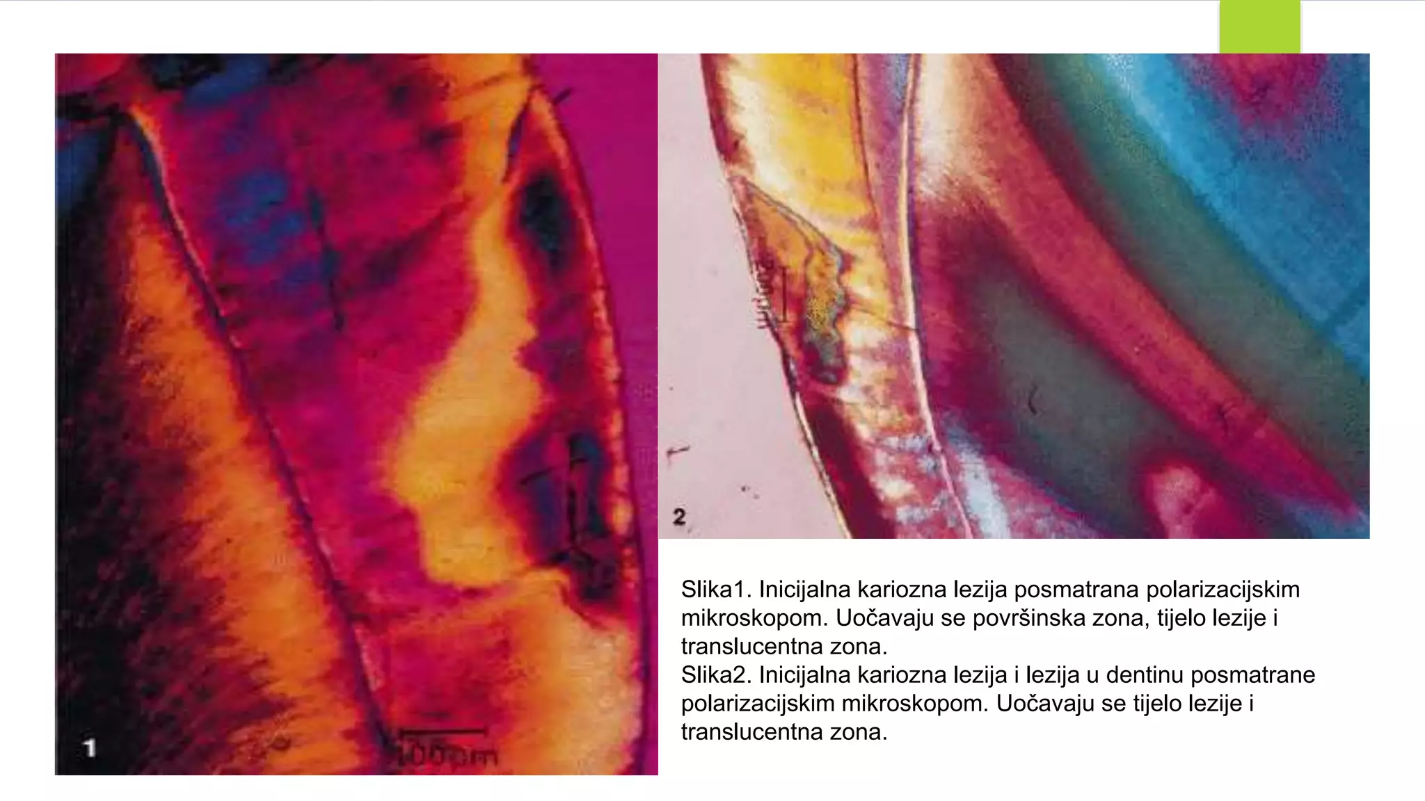 Inicijalna kariozna lezija, dijagnoza i terapija | PPTX