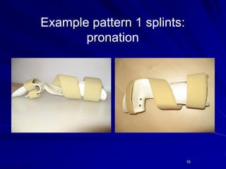 Resting splint research splint provision charlie laver | PPT