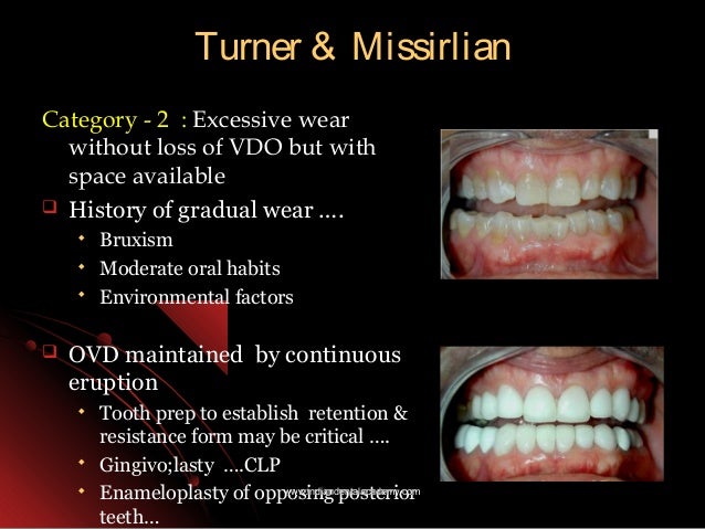 Rest of lost vert dim/ academy general dentistry