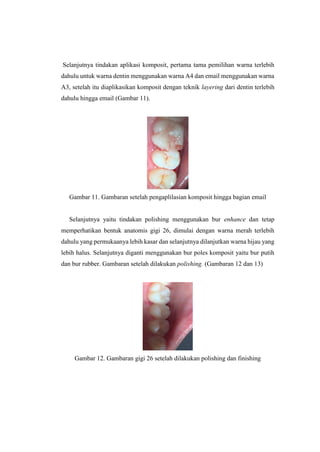 Restorasi direk komposit kelas ii pasca ginggivectomy gigi 26 | PDF