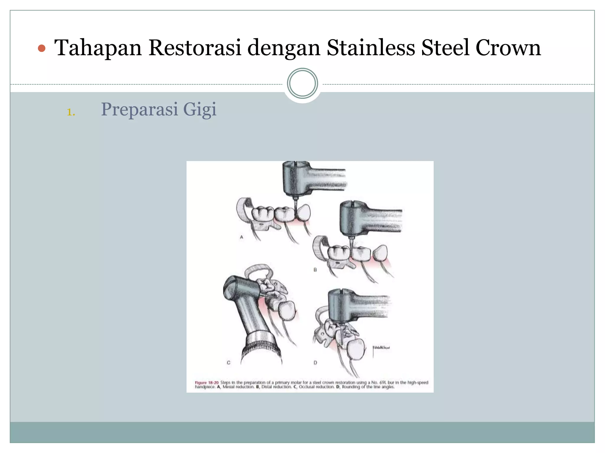 Restorasi gigi sulung | PPTX