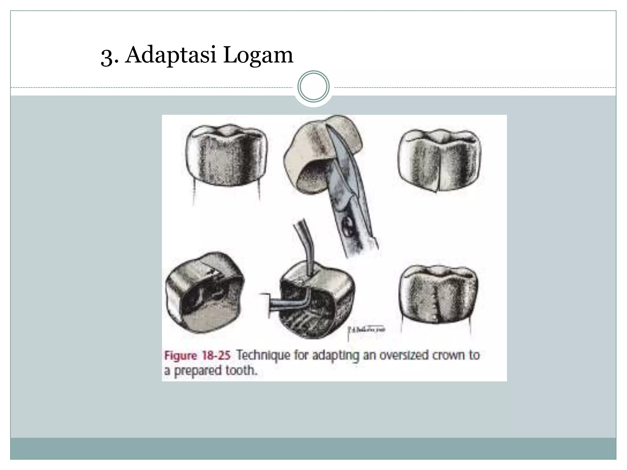 Restorasi gigi sulung | PPTX