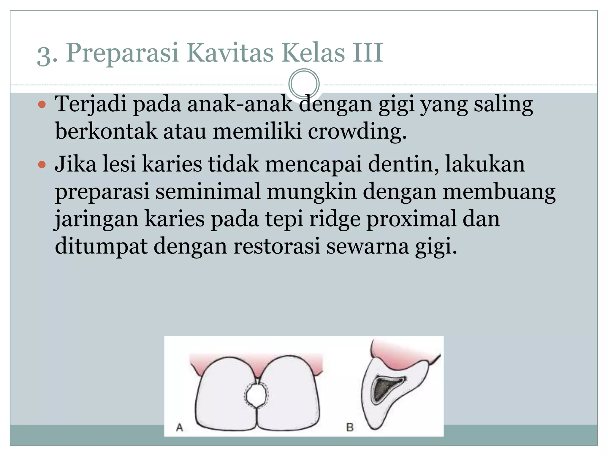 Restorasi gigi sulung | PPTX