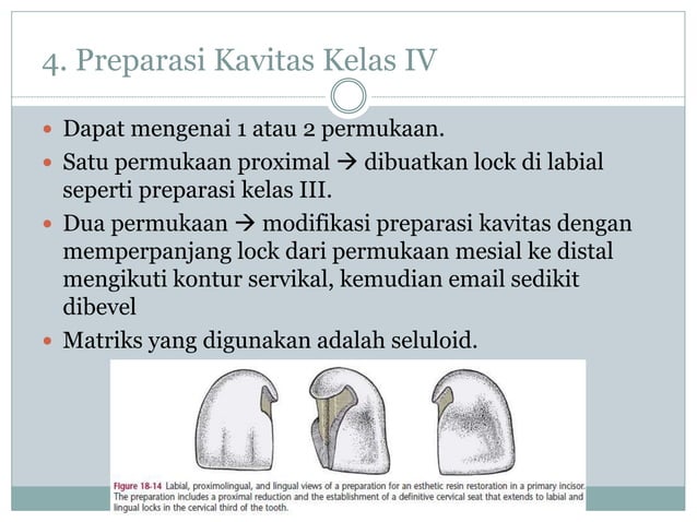 Restorasi gigi sulung | PPTX