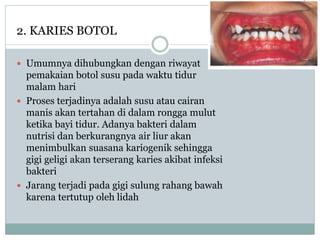 Restorasi gigi sulung | PPTX