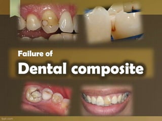 Restoration failure | PPTX