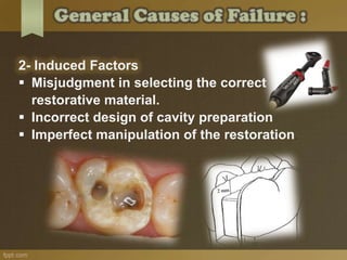 Restoration failure | PPTX