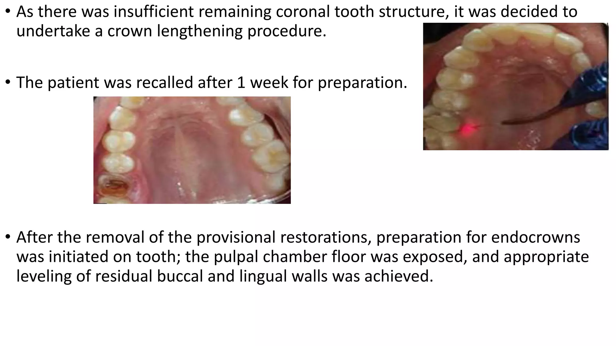 Restoration of badly broken teeth | PPTX