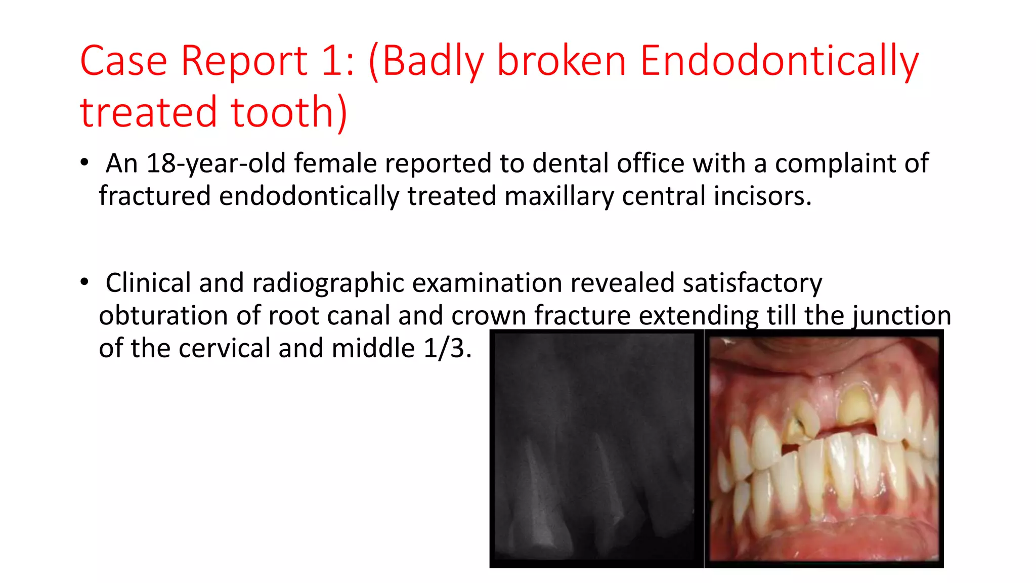 Restoration of badly broken teeth | PPTX