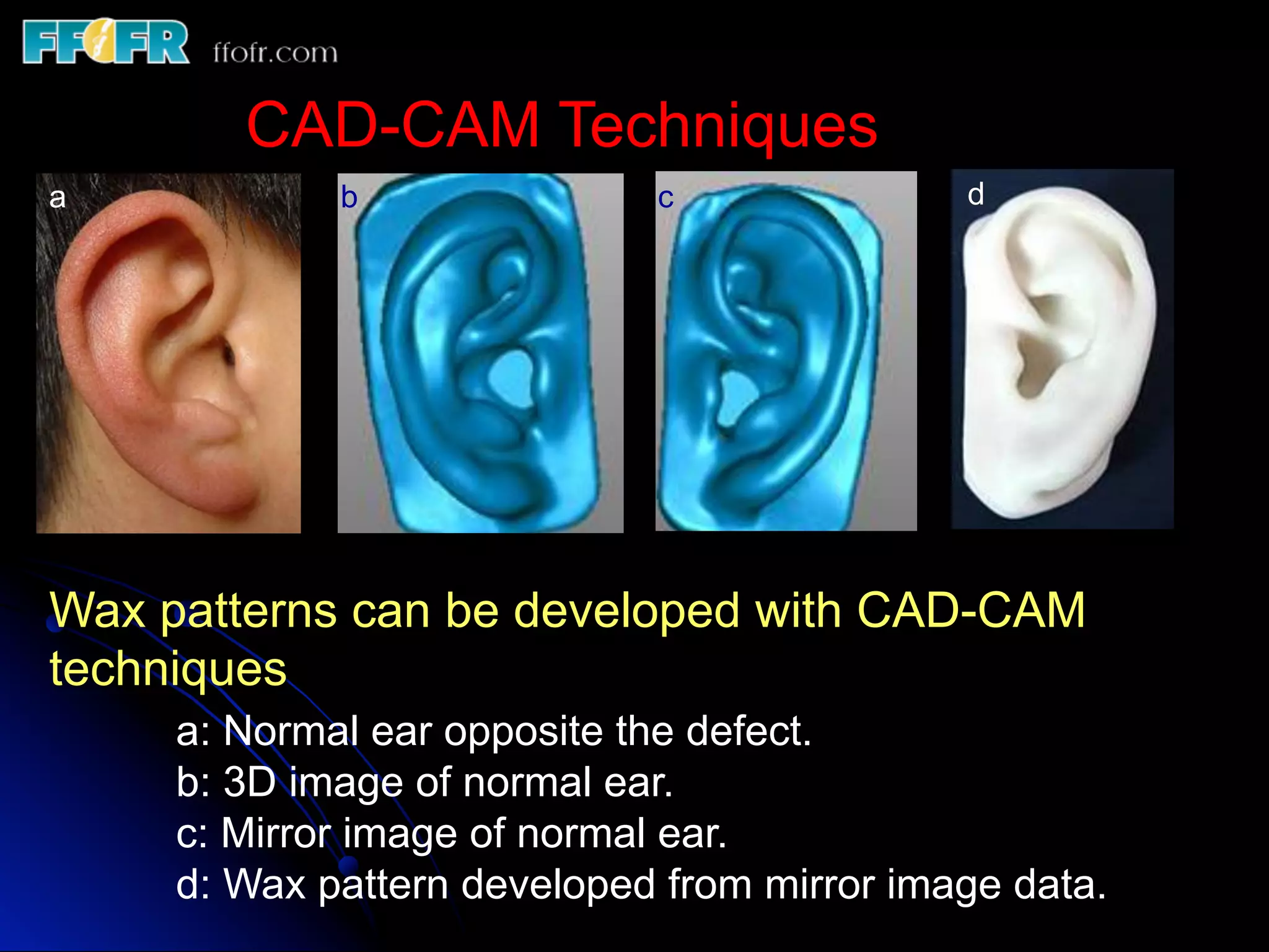 Restoration of ear defects | PDF