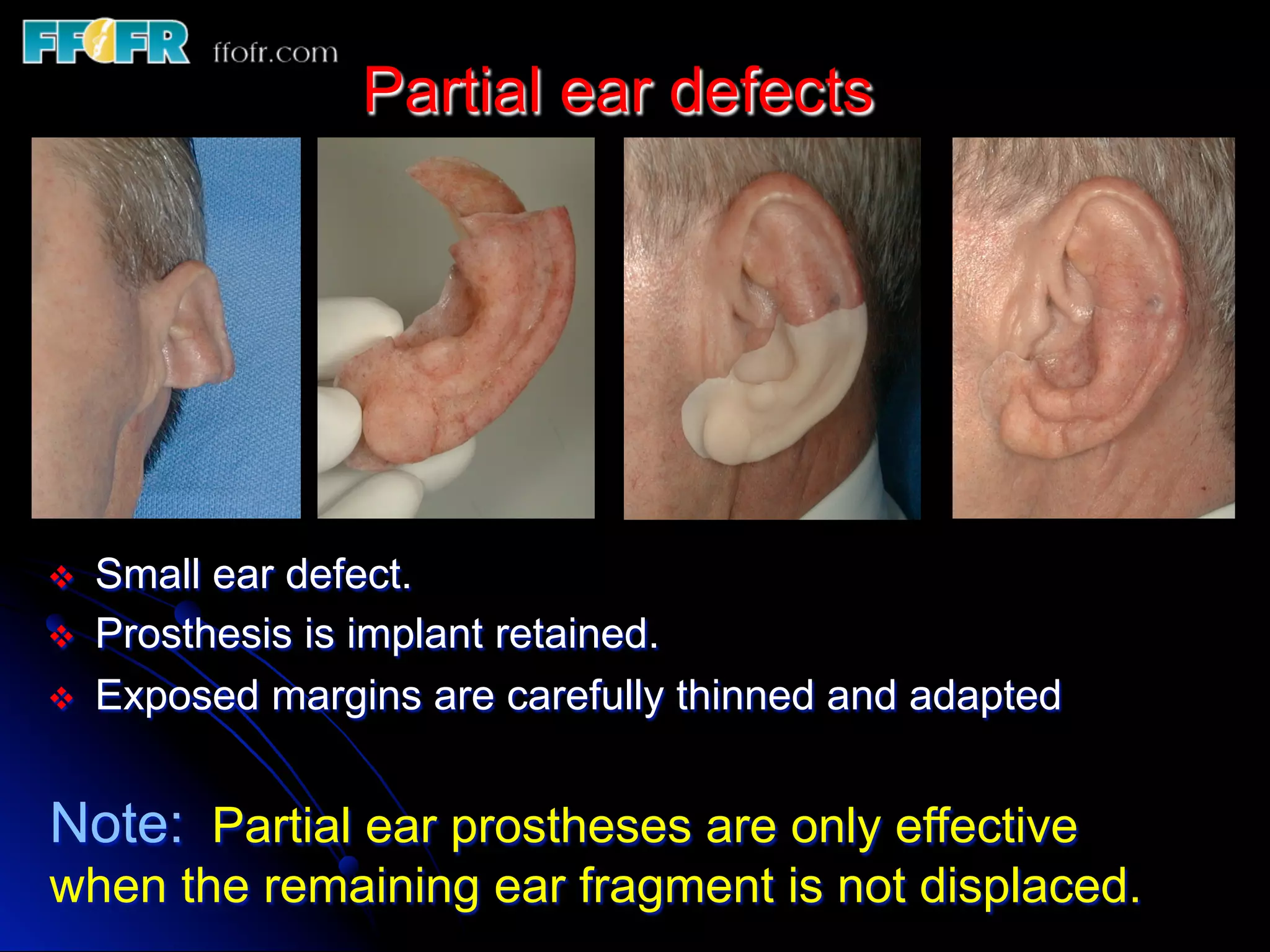 Restoration of ear defects | PDF